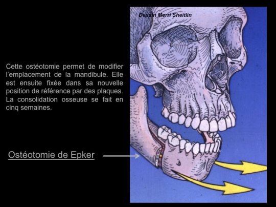 La chirurgie orthognatique - Implants dentaires Paris et Toulouse avec ...